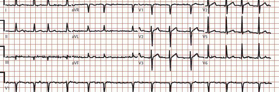 Atriumfibrilleren in de anesthesiologische praktijk | Prelum Academy