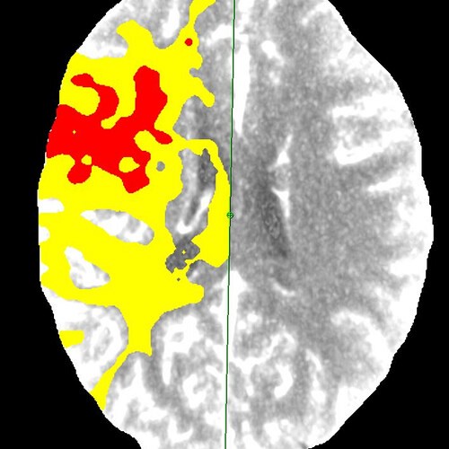 Beroerte bij kinderen | Prelum Academy