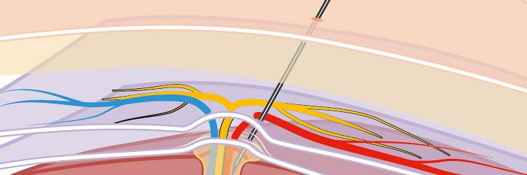 Anterior Cutaneous Nerve Entrapment Syndrome | Prelum Academy