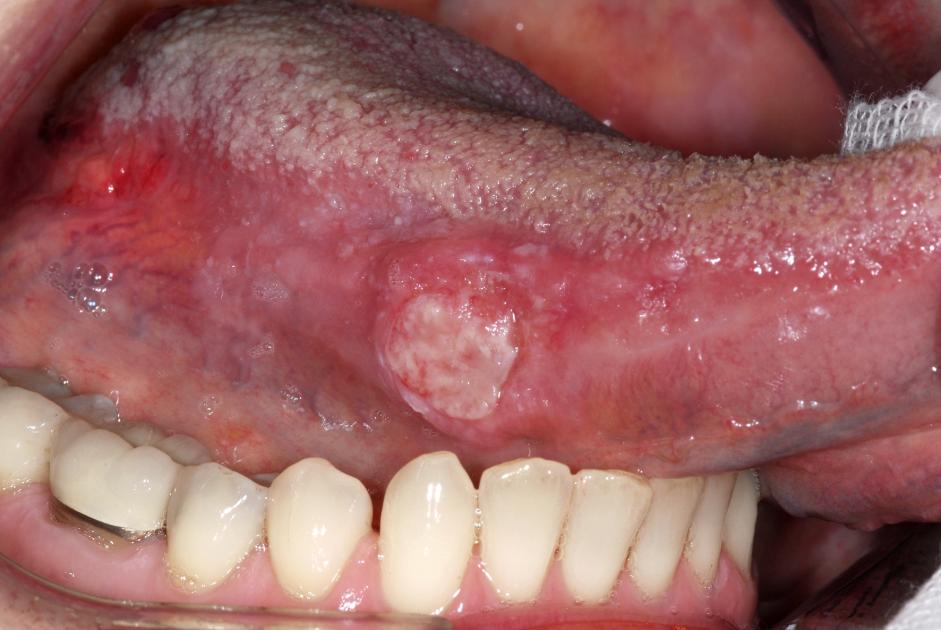 Mondkanker | Prelum Academy