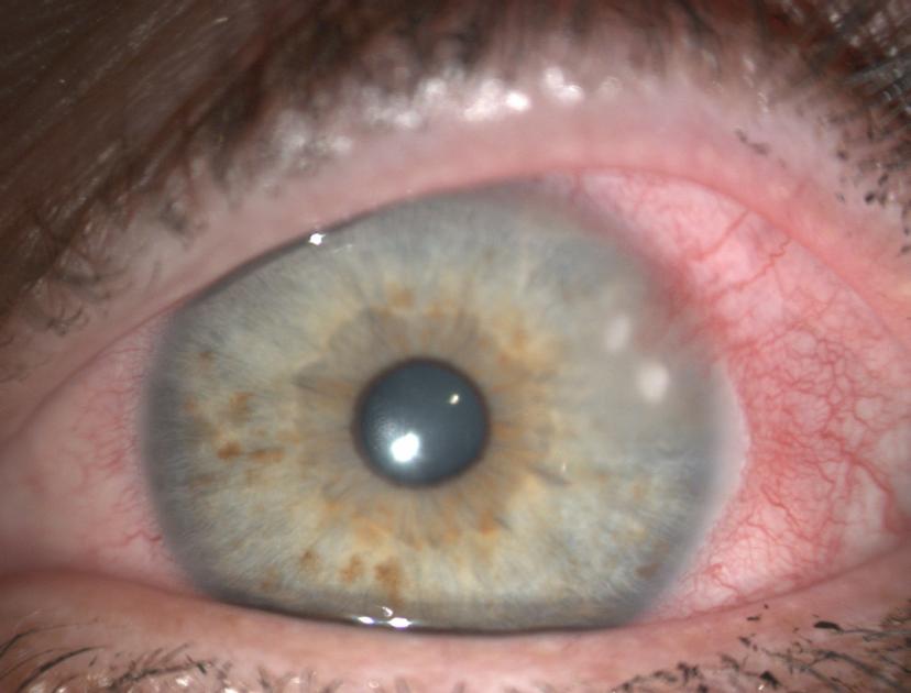 Rode ogen, traanogen en ‘plakogen’ | Prelum Academy