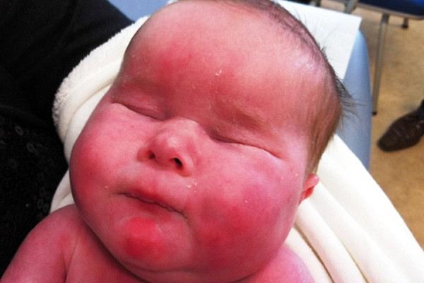 Plaatjespuzzel: een baby met harde, pijnlijke plekken in de huid ...